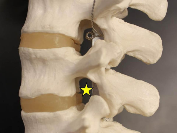 intervertebral foramina – The Academy of Systematic Kinesiology